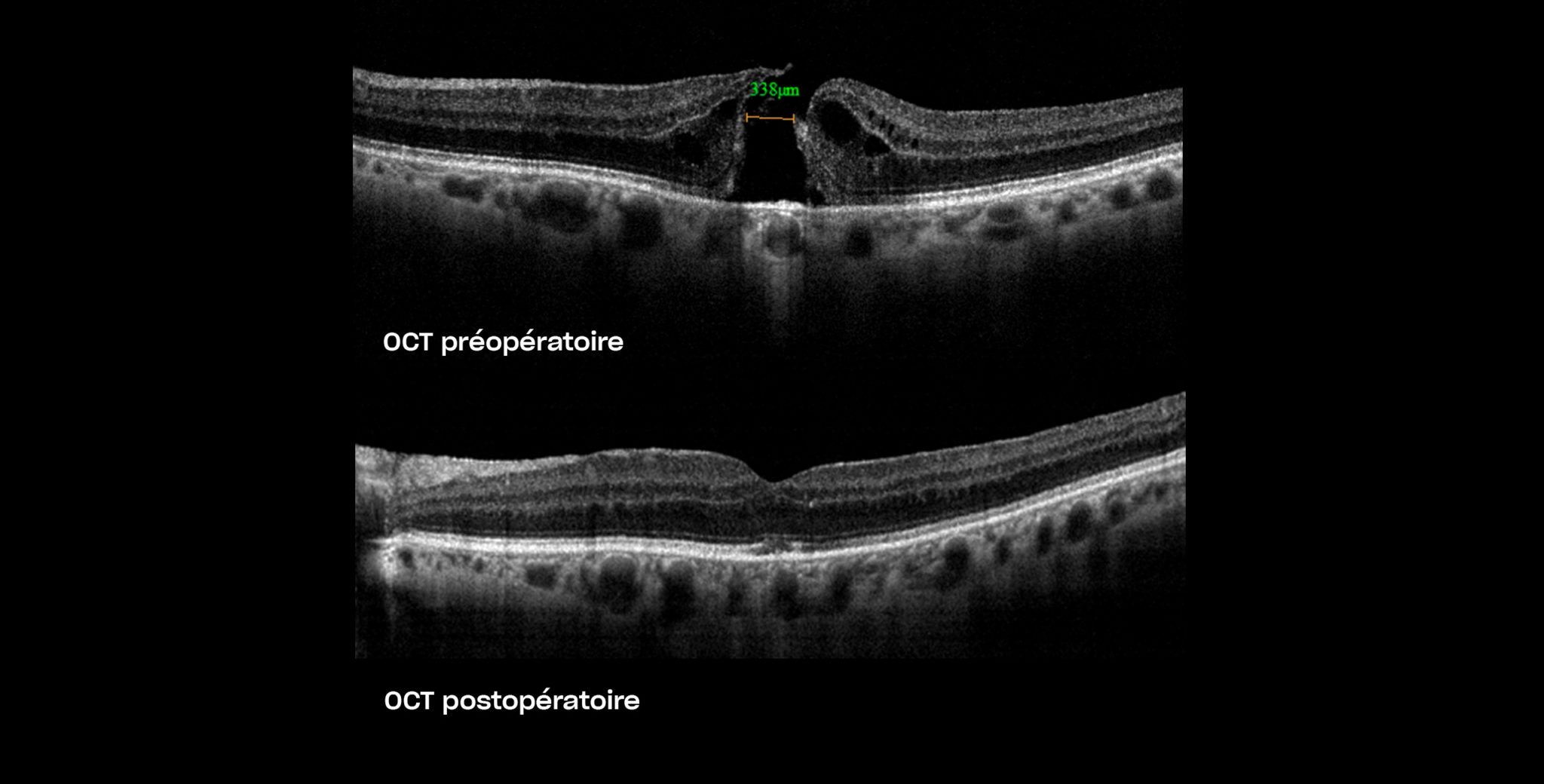Traitement du trou maculaire à Paris au Centre Ophtalmologique COSS
