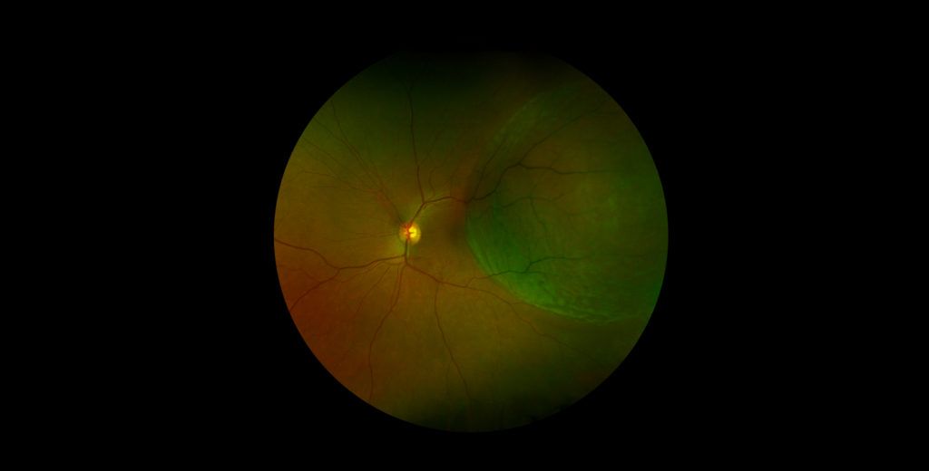 Décollement de la rétine : diagnostic et traitement à Paris au Centre COSS
