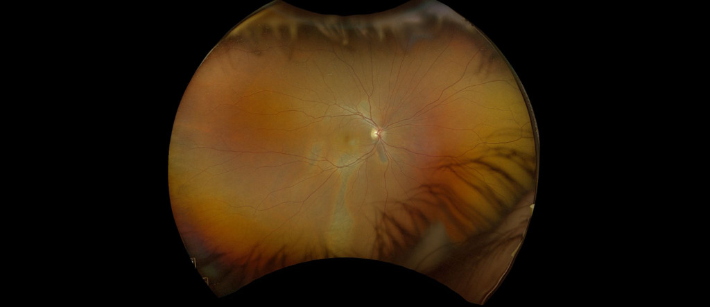 Le laser YAG pour le traitement des maladies des yeux